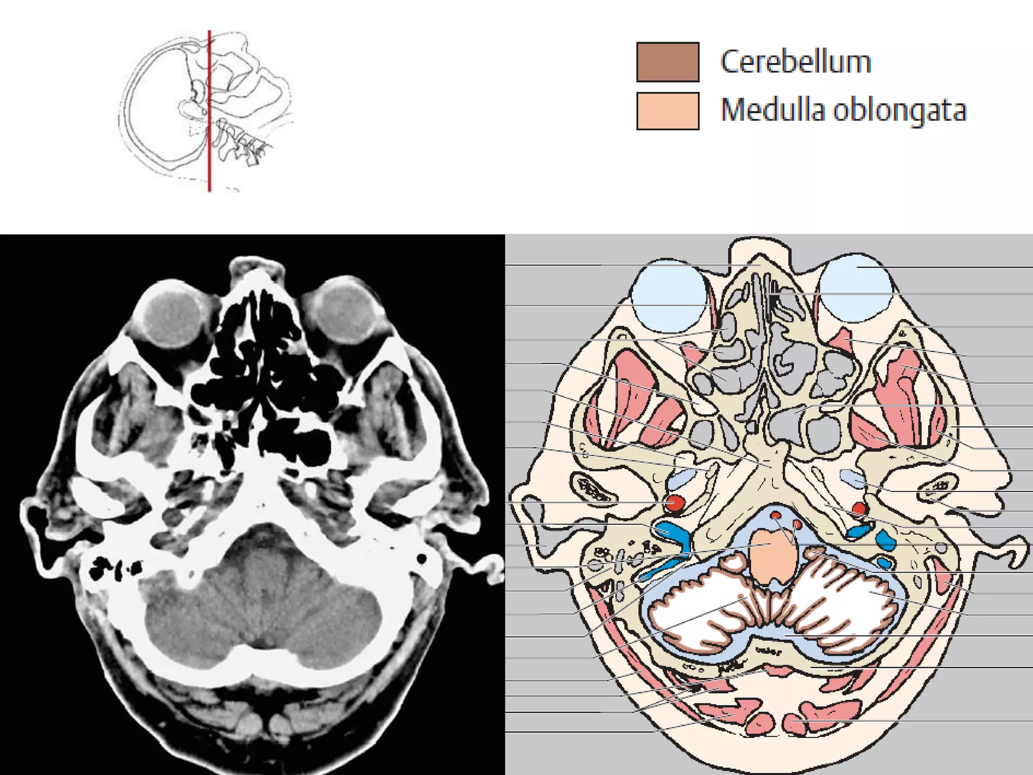BASICS of CT Head | PPTX