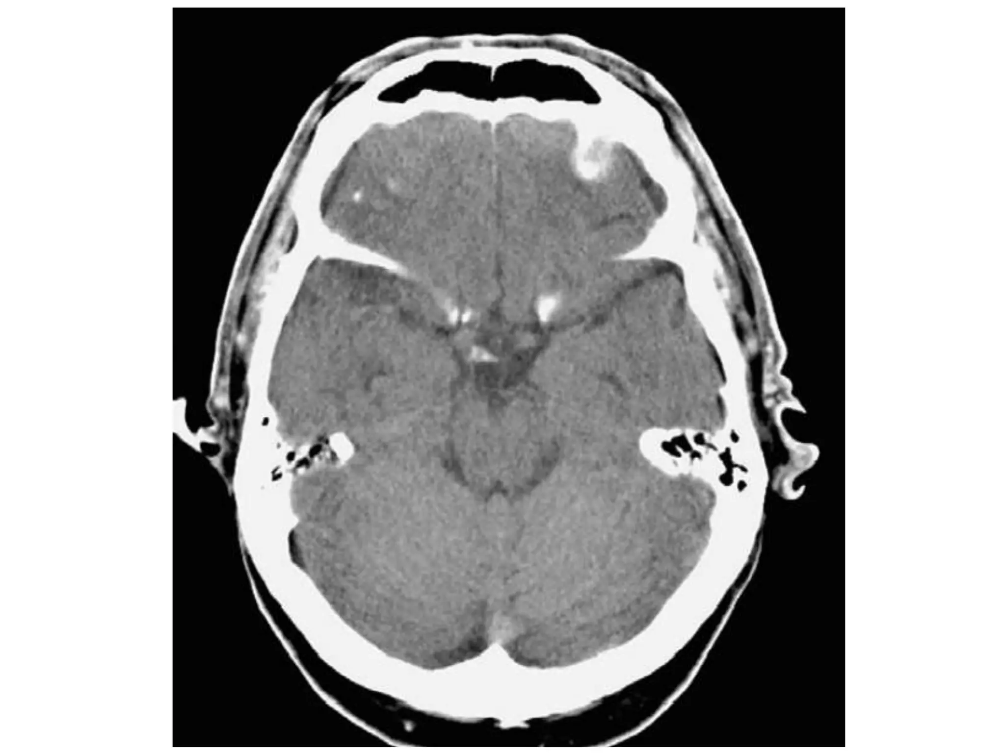 BASICS of CT Head | PPTX
