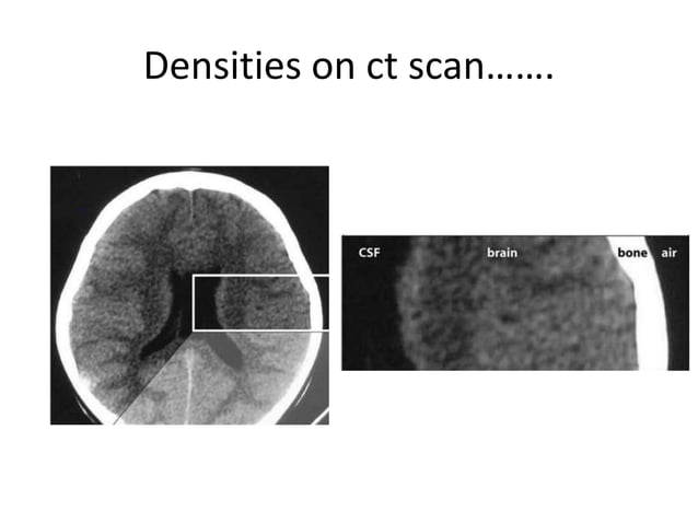 BASICS of CT Head | PPTX
