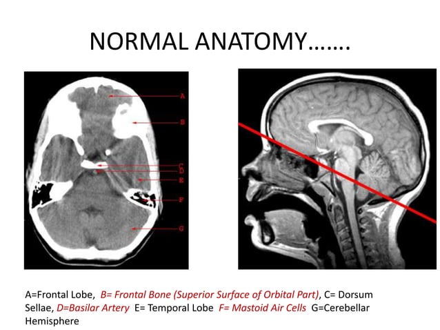 BASICS of CT Head | PPTX