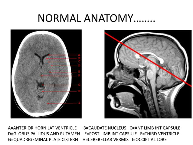BASICS of CT Head | PPTX