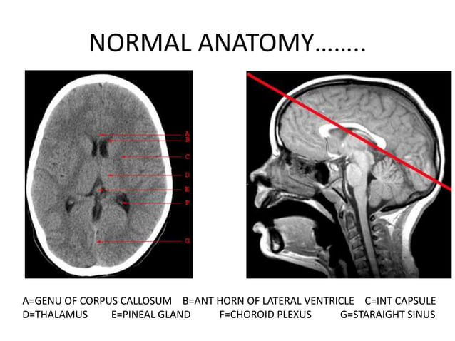 BASICS of CT Head | PPTX