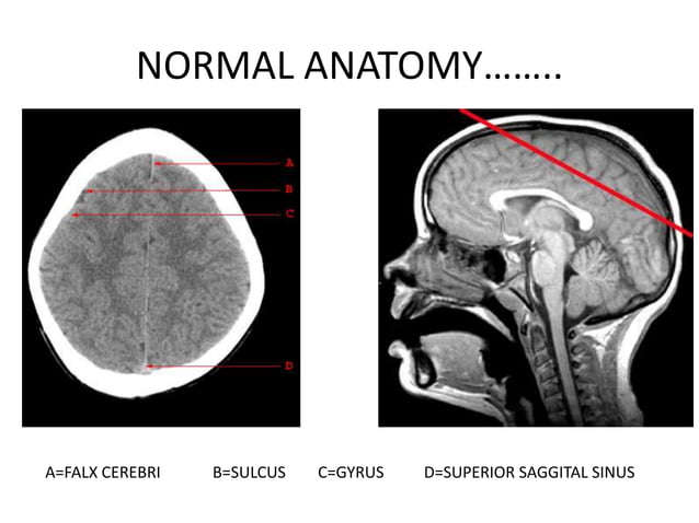 BASICS of CT Head | PPTX