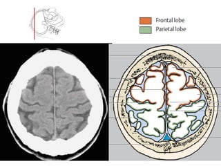 BASICS of CT Head | PPTX