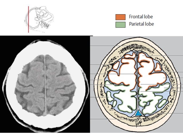 BASICS of CT Head | PPTX