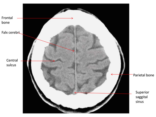 BASICS of CT Head | PPTX
