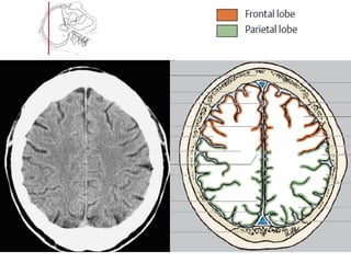 BASICS of CT Head | PPTX
