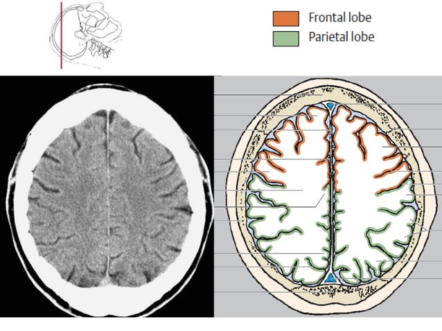 BASICS of CT Head | PPTX