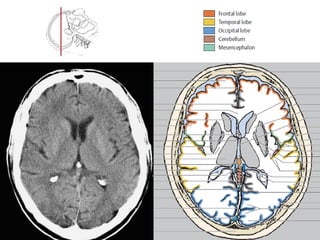 BASICS of CT Head | PPTX