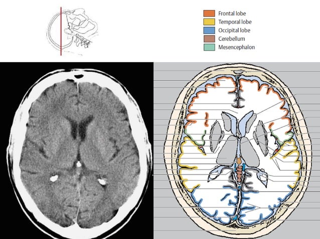 BASICS of CT Head | PPTX
