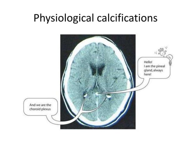 BASICS of CT Head | PPTX