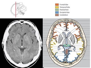BASICS of CT Head | PPTX