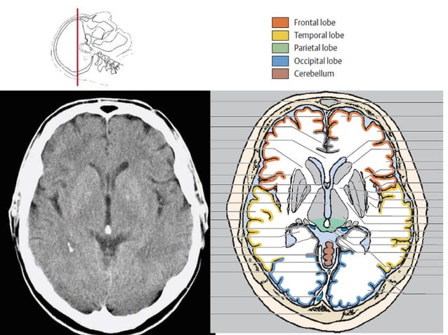 BASICS of CT Head | PPTX