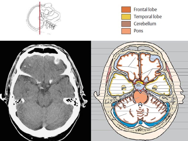 BASICS of CT Head | PPTX
