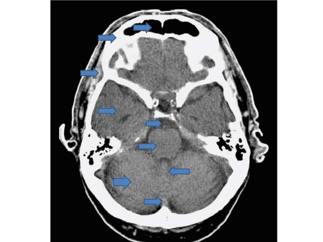 BASICS of CT Head | PPTX