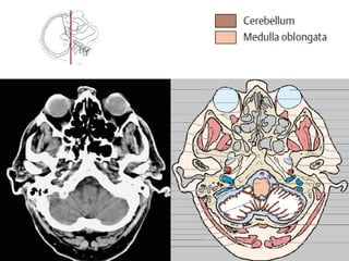 BASICS of CT Head | PPTX