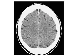 BASICS of CT Head | PPTX