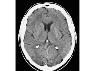 BASICS of CT Head | PPTX