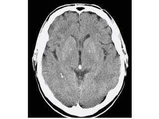 BASICS of CT Head | PPTX