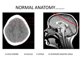 Normal Brain Ct Anatomy