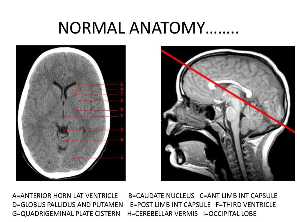 BASICS of CT Head