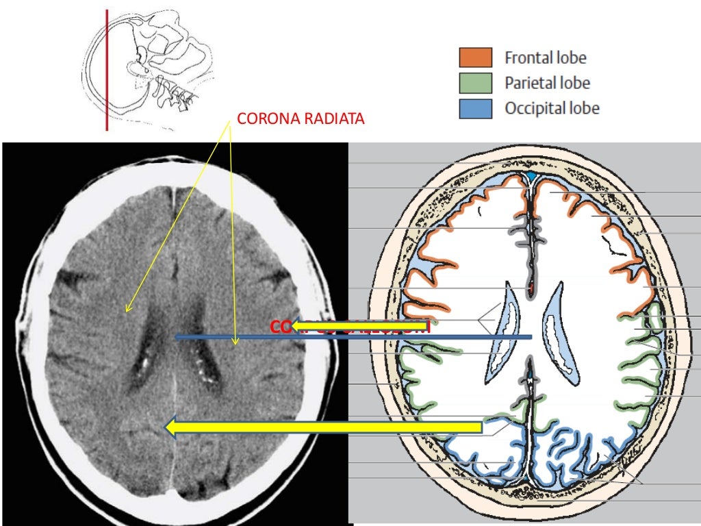 BASICS of CT Head