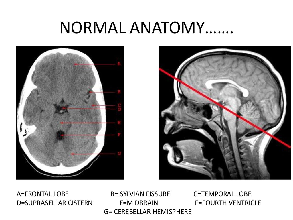 BASICS of CT Head
