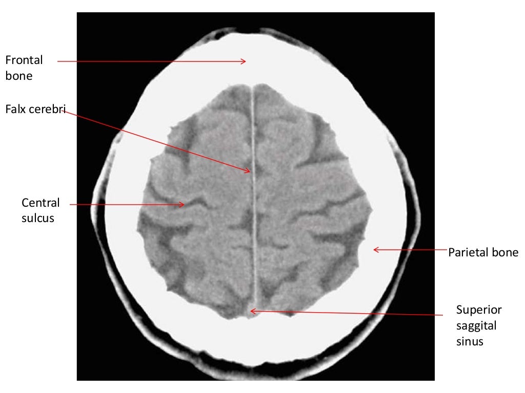 BASICS of CT Head