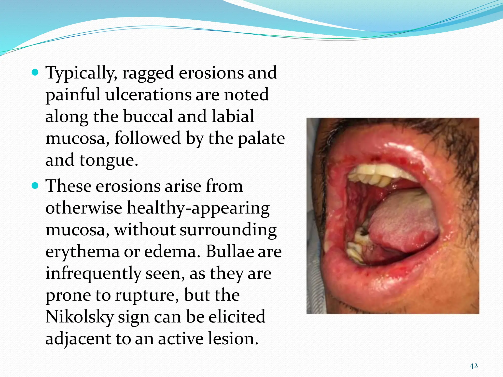Desquamative Gingivitis (detailed presentation.pptx