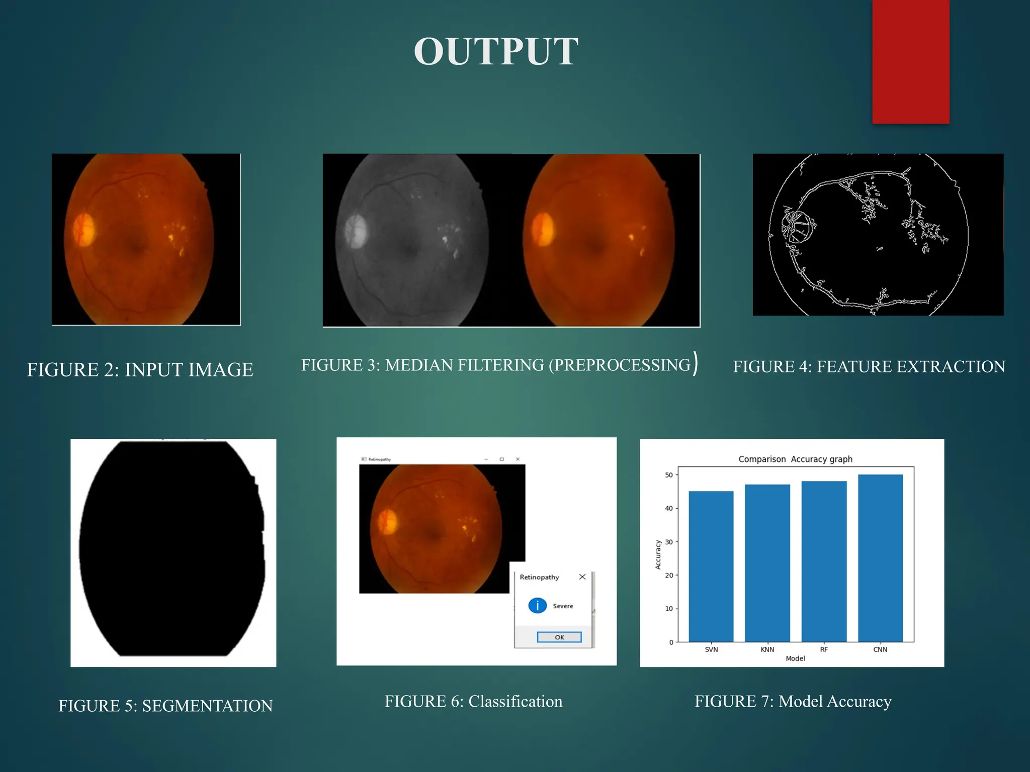 Diabetic Retinopathy using image processing | PPTX
