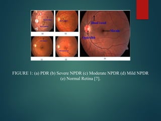 Diabetic Retinopathy using image processing | PPTX