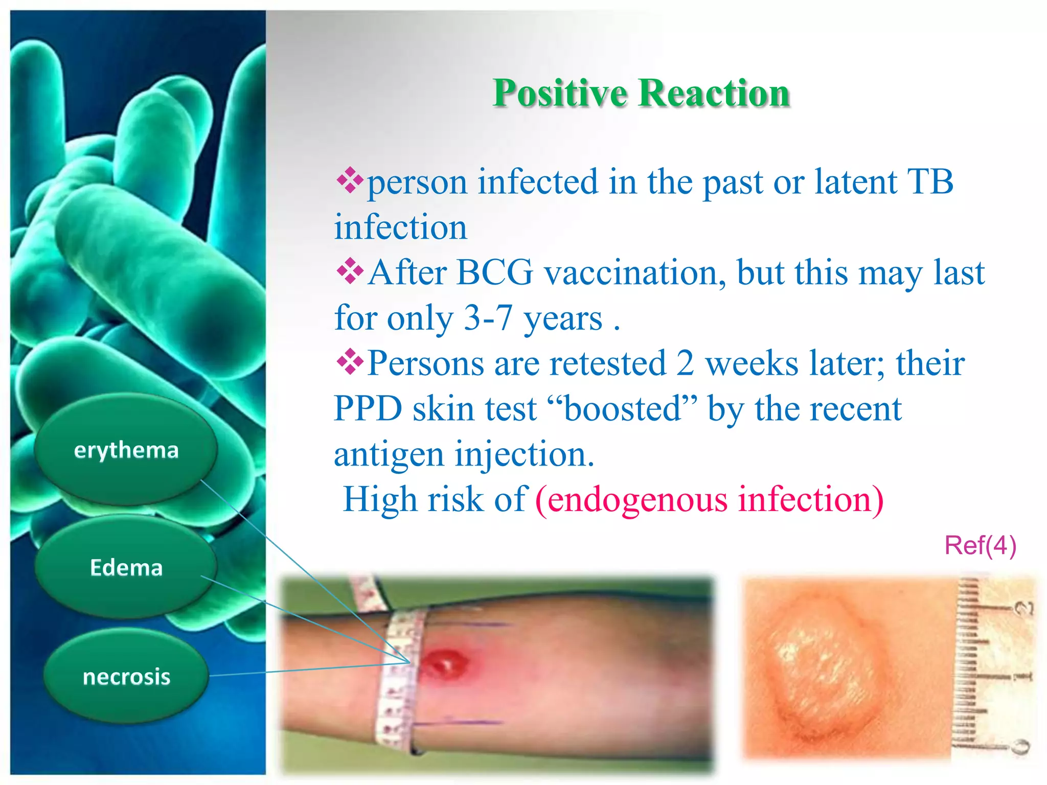pulmonary tuberculosis | PPTX