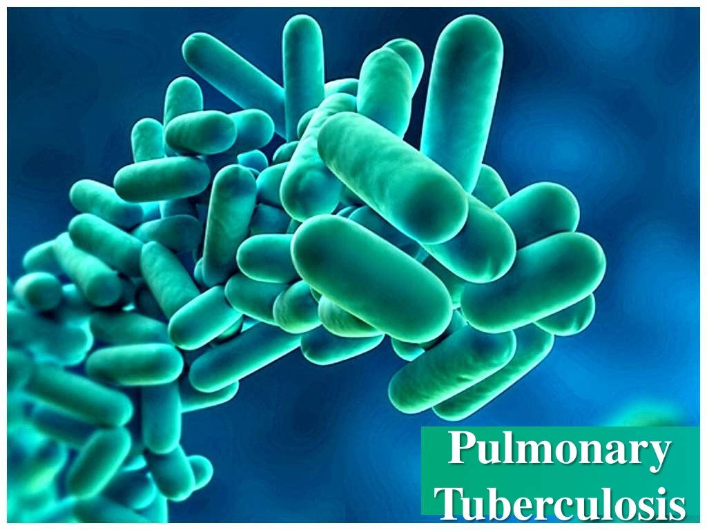 pulmonary tuberculosis