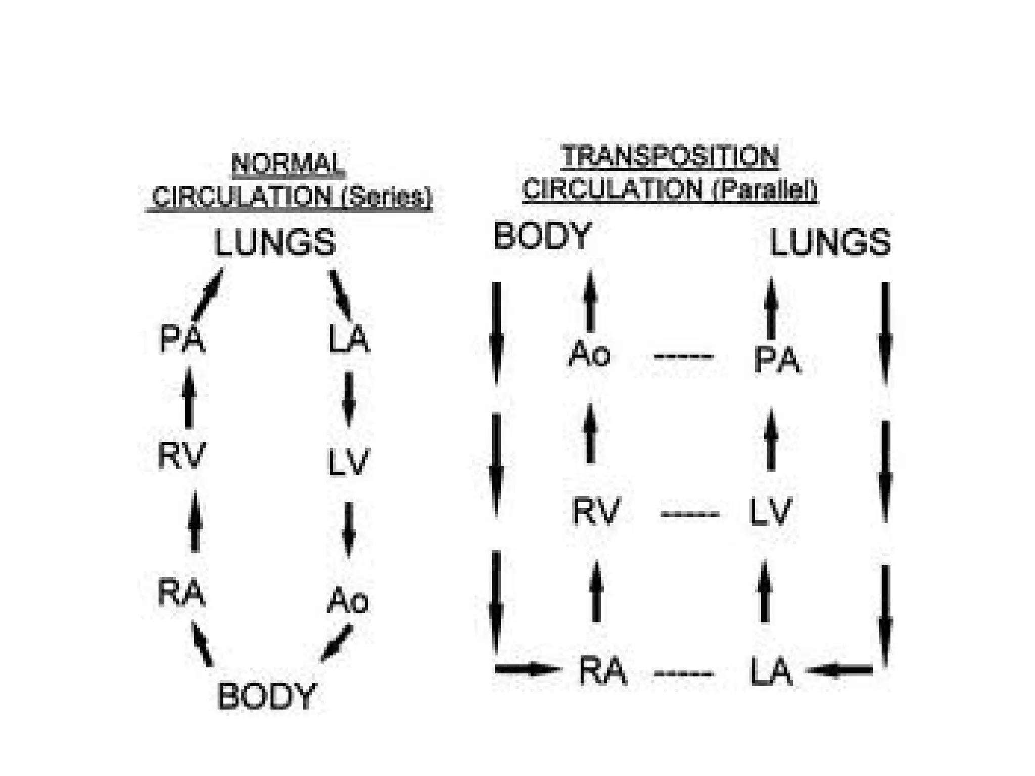 Transposition of Great Arteries | PPT
