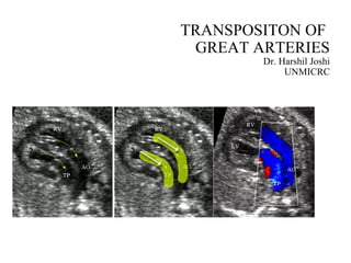 Transposition Of The Great Arteries Ultrasound