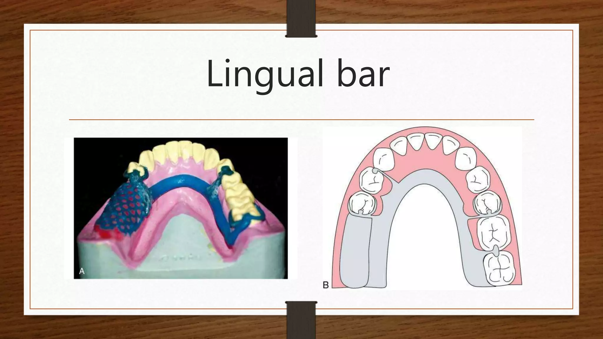 Major and minor connectors | PPTX | Dental Health | Diseases and Conditions