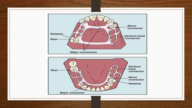 Major and minor connectors | PPTX | Dental Health | Diseases and Conditions