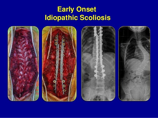 Early onset scoliosis Early onset scoliosis