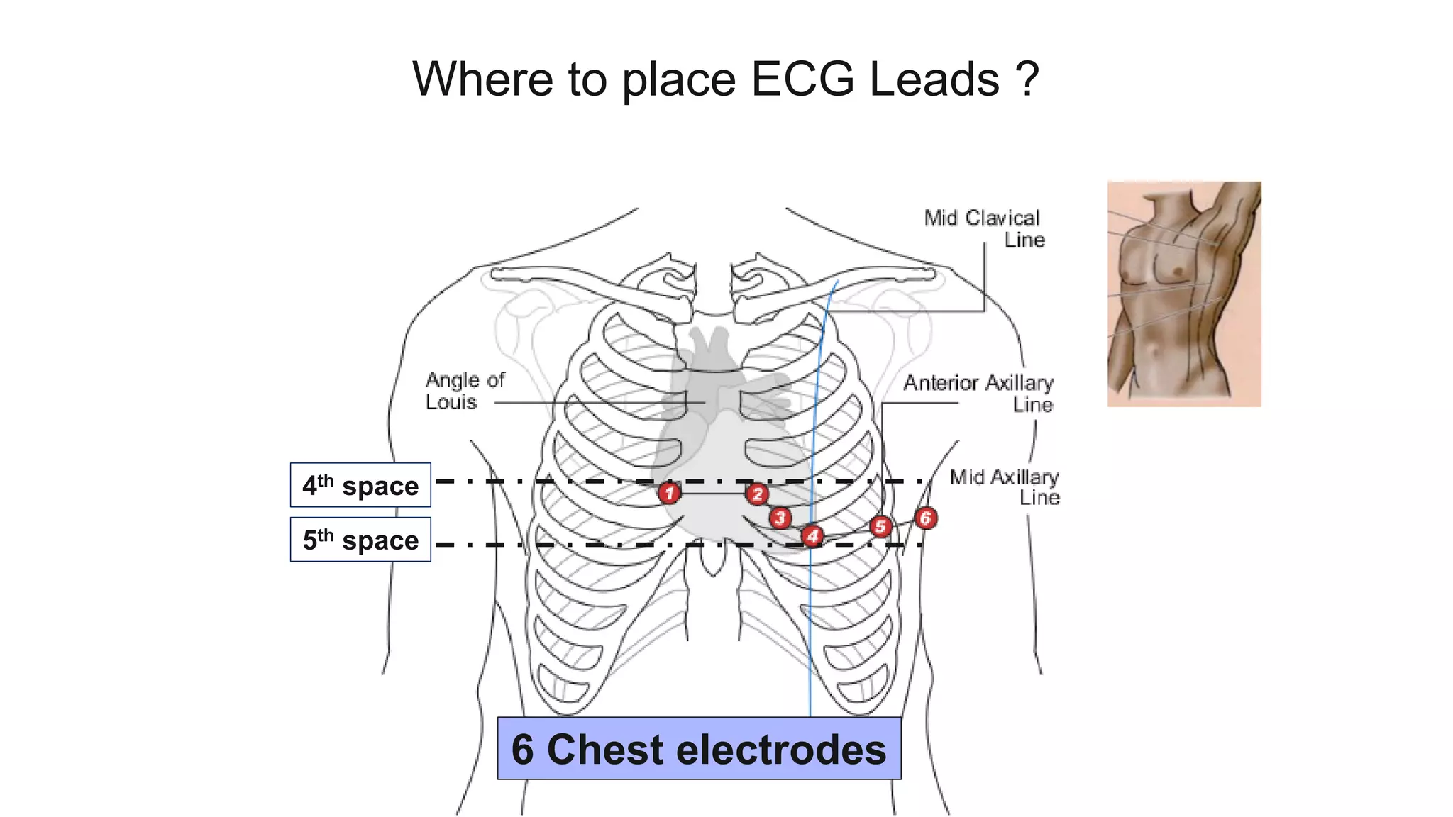 ECG made easy | PDF