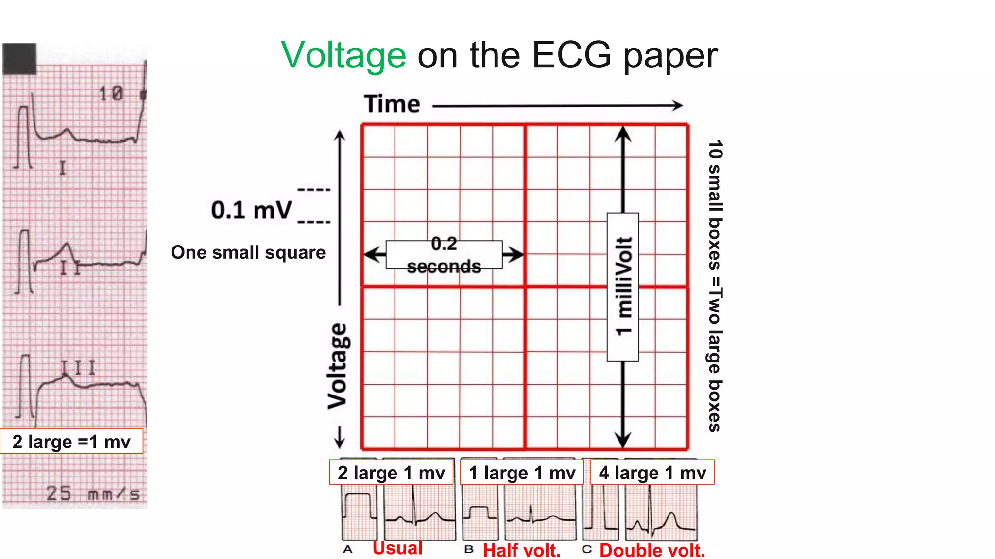 ECG made easy | PDF