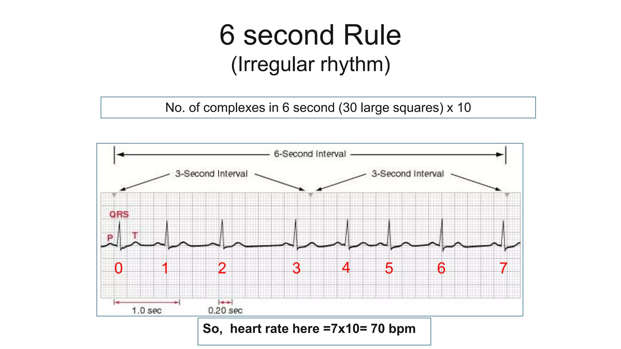ECG made easy | PDF
