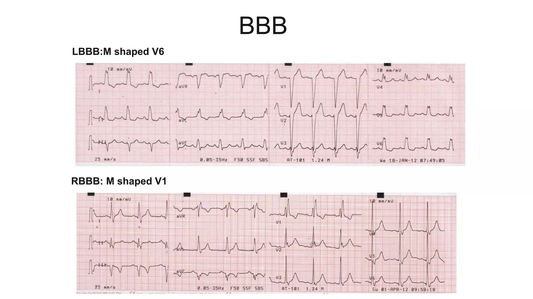 ECG made easy | PDF