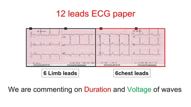 ECG made easy | PDF