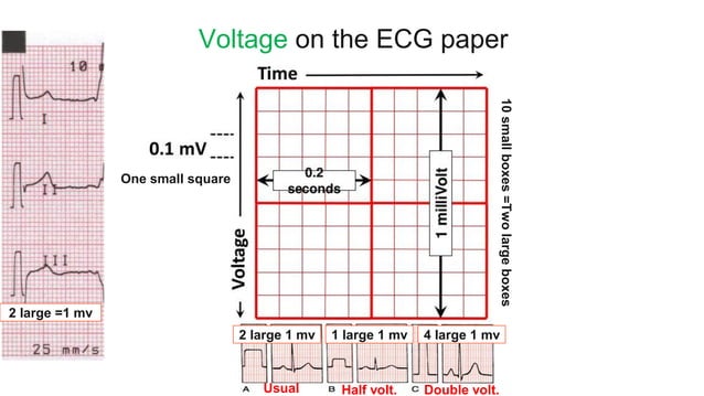 ECG made easy | PDF