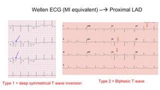 ECG made easy | PDF
