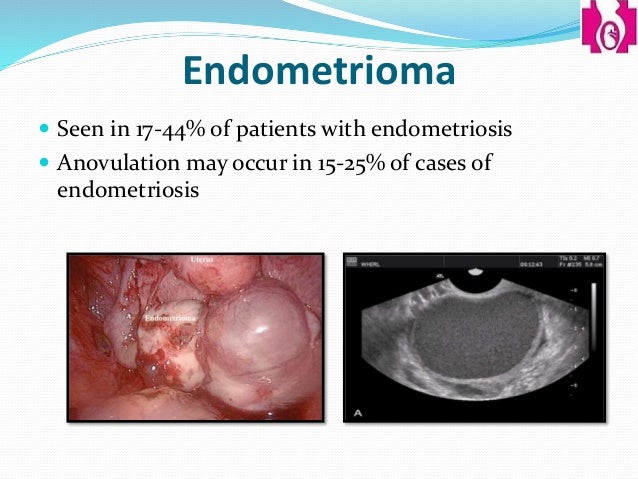 Laparoscopic management of endometriosis