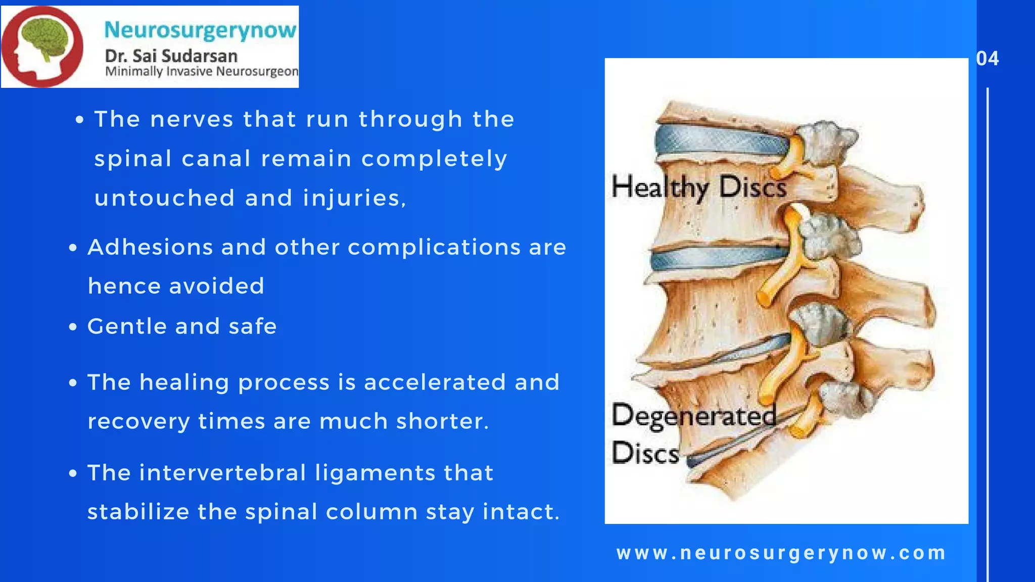 Endoscopic Lumbar Discectomy Ppt