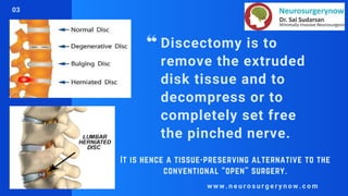Endoscopic lumbar discectomy | PDF
