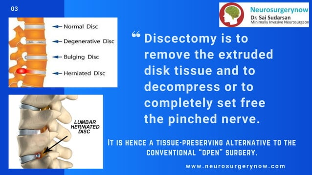 Endoscopic lumbar discectomy | PDF