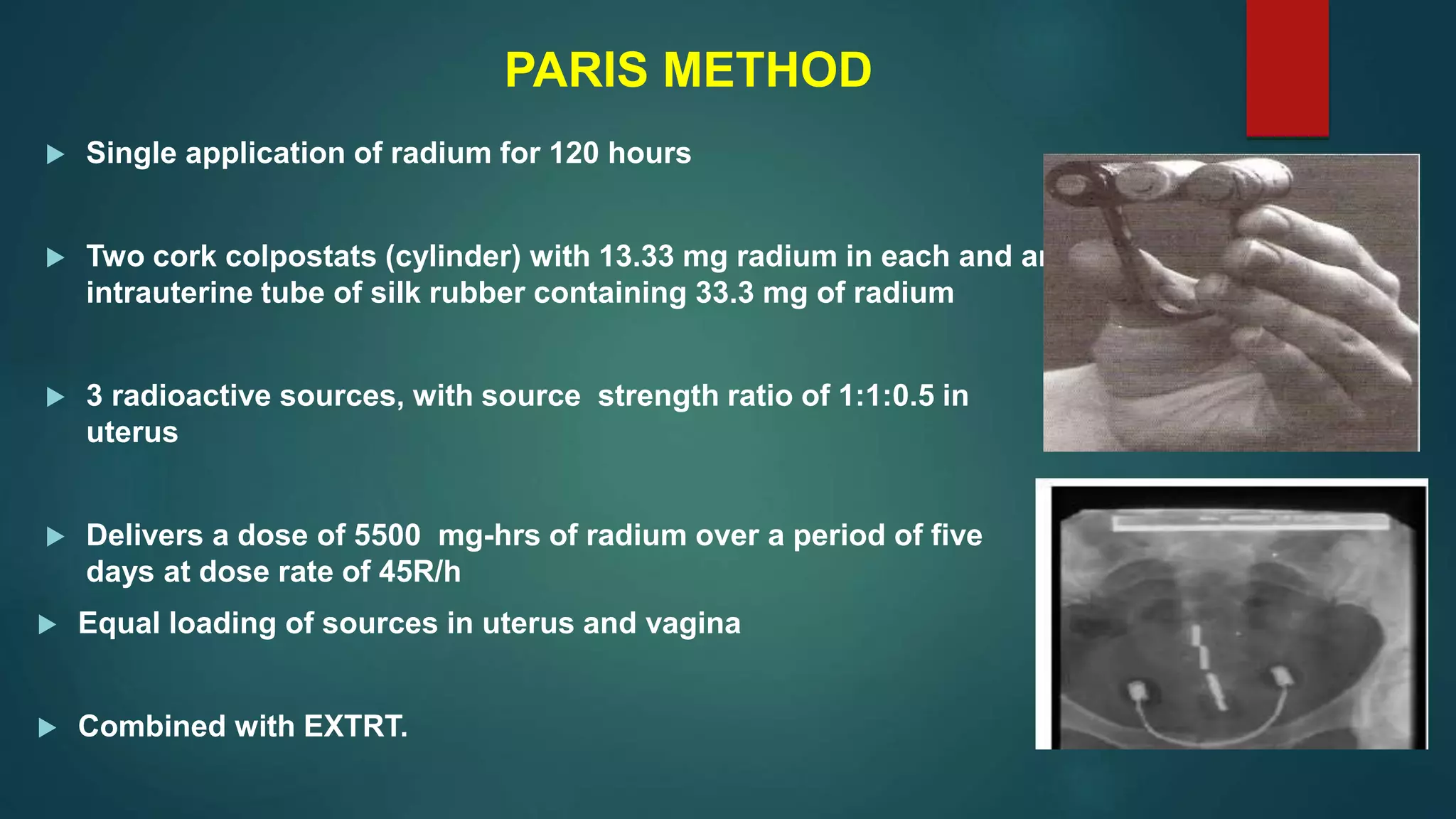 Evolution of Intracavitary brachytherapy for carcinoma of cervix | PPTX